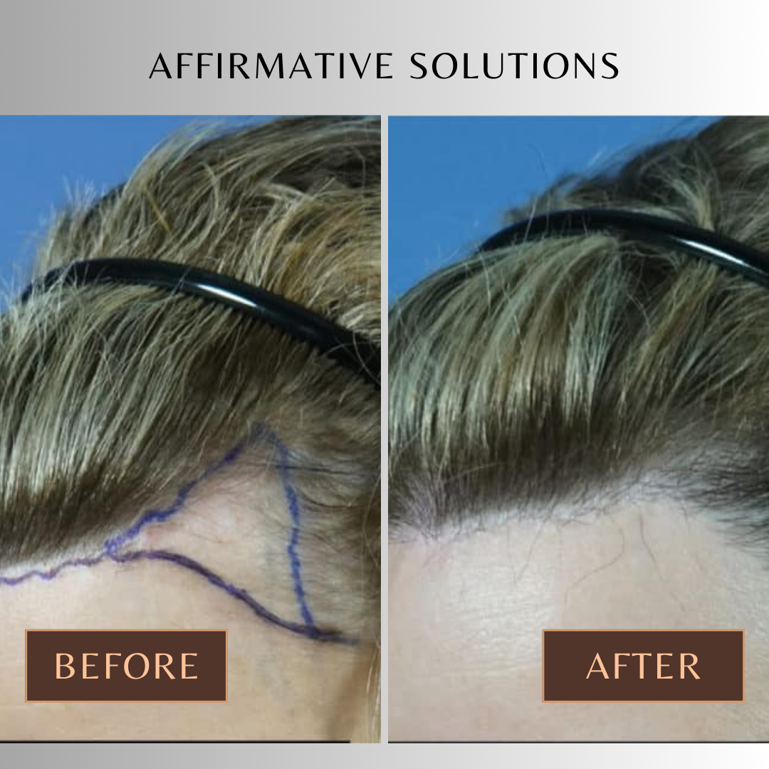 Female Hair Transplant Turkey: Great Results No Shave